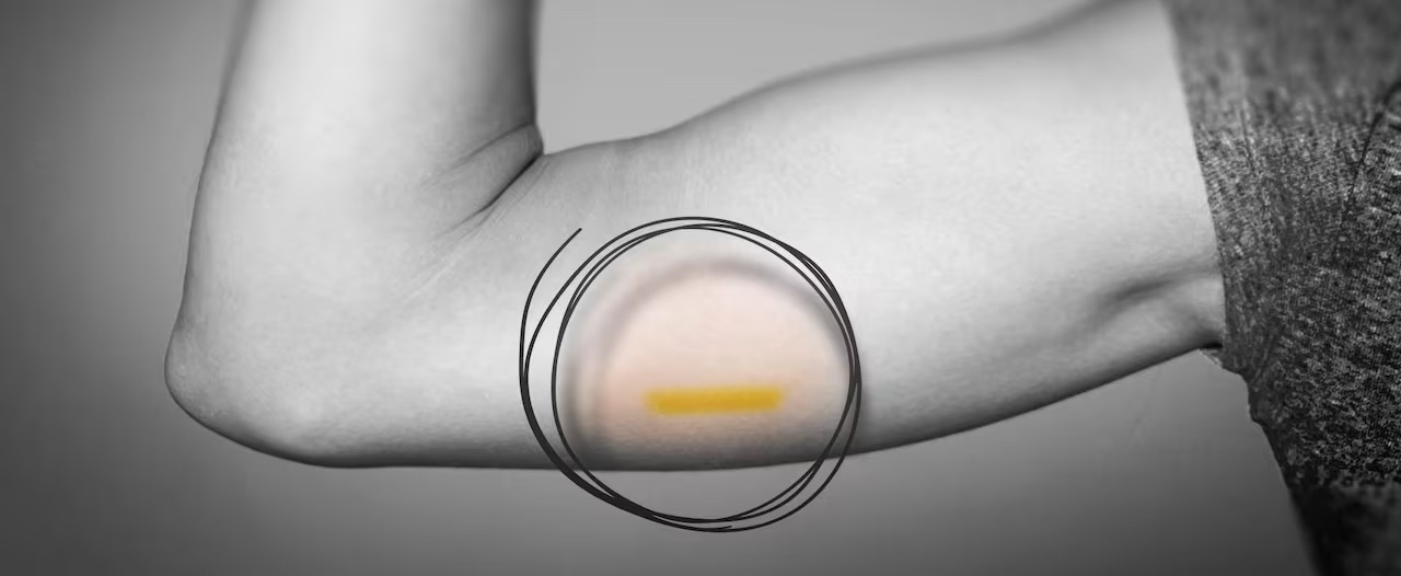 Nexplanon Contraceptive Implant Cambridge Private Doctors